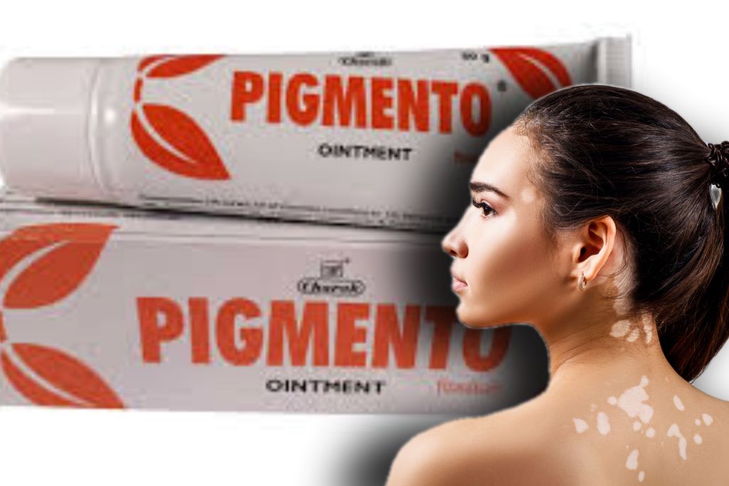 White Spot Natural Ayurvedic Pigmento Cream 50g For White patches ...